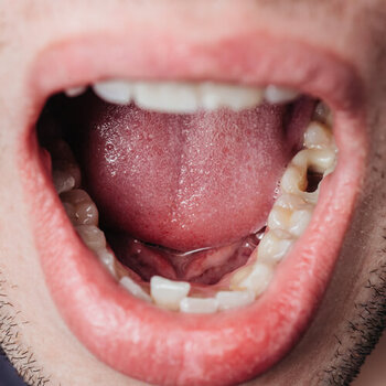 What Are the First Signs of Sepsis from a Tooth Abscess? | Hyster Home